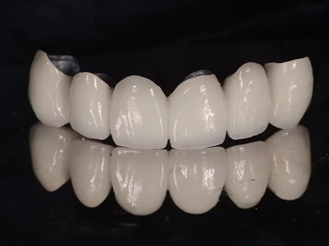 Metal Crowns - OGN Dental Studio